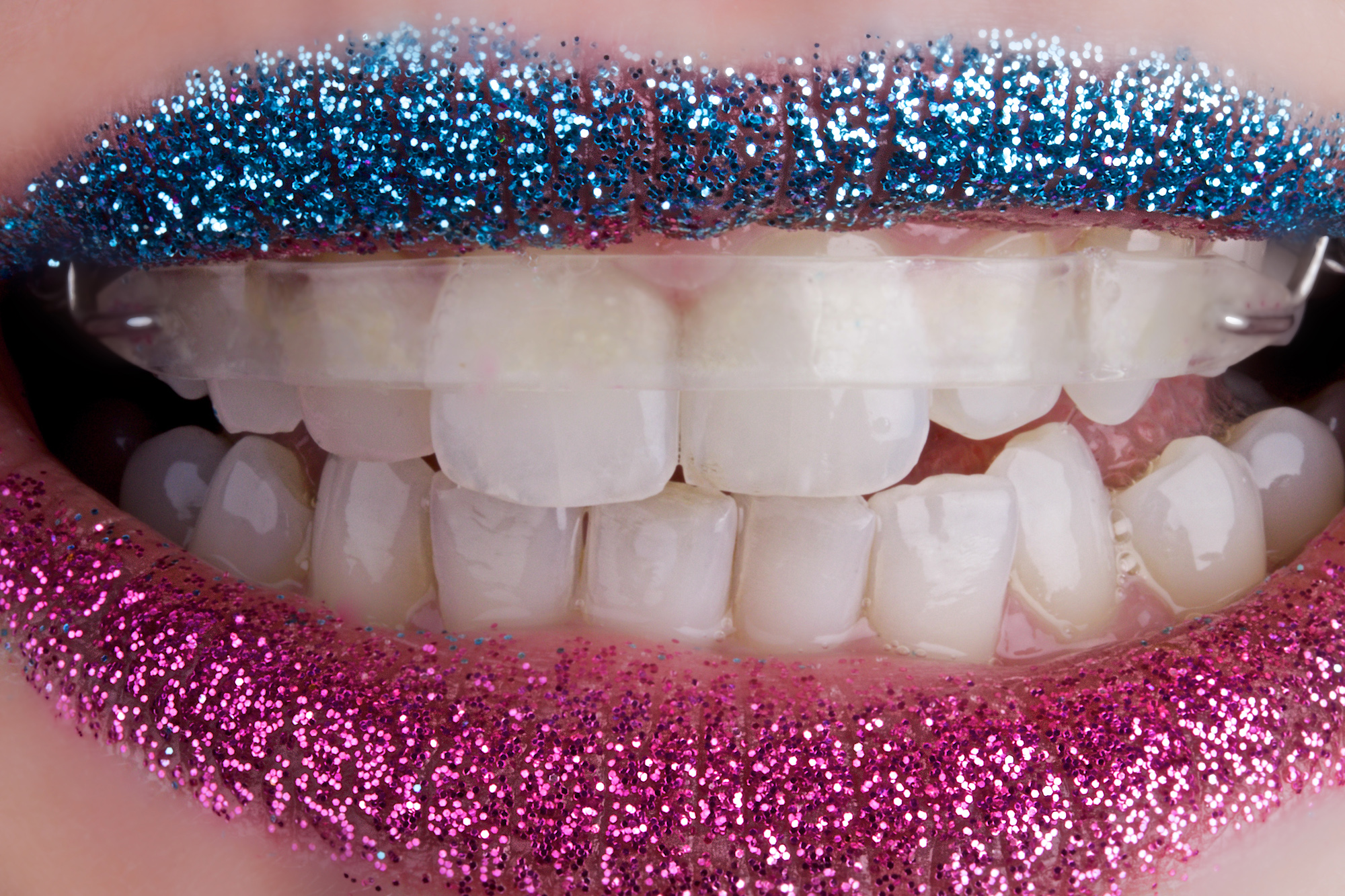 Inman Aligner - Sparklysmile Dental Blackheath